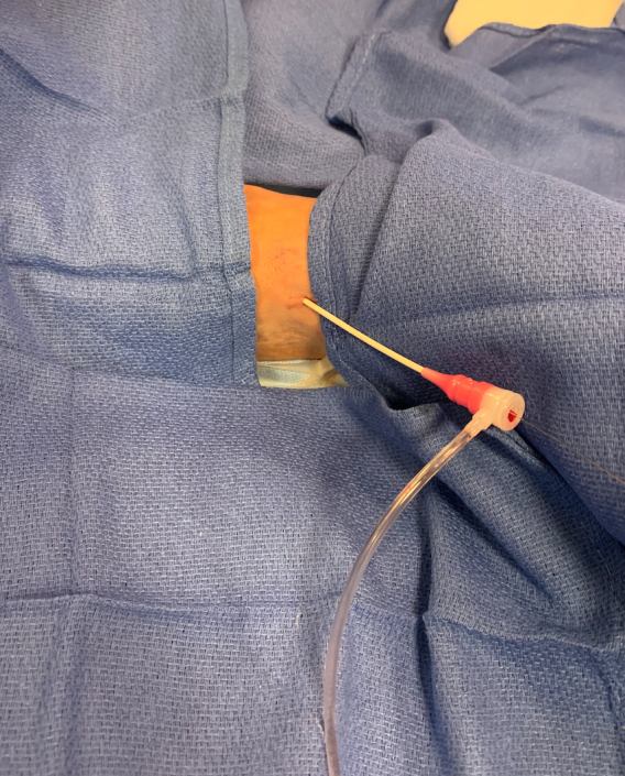 Understanding Leg Wound Ischemia: Causes and Treatments