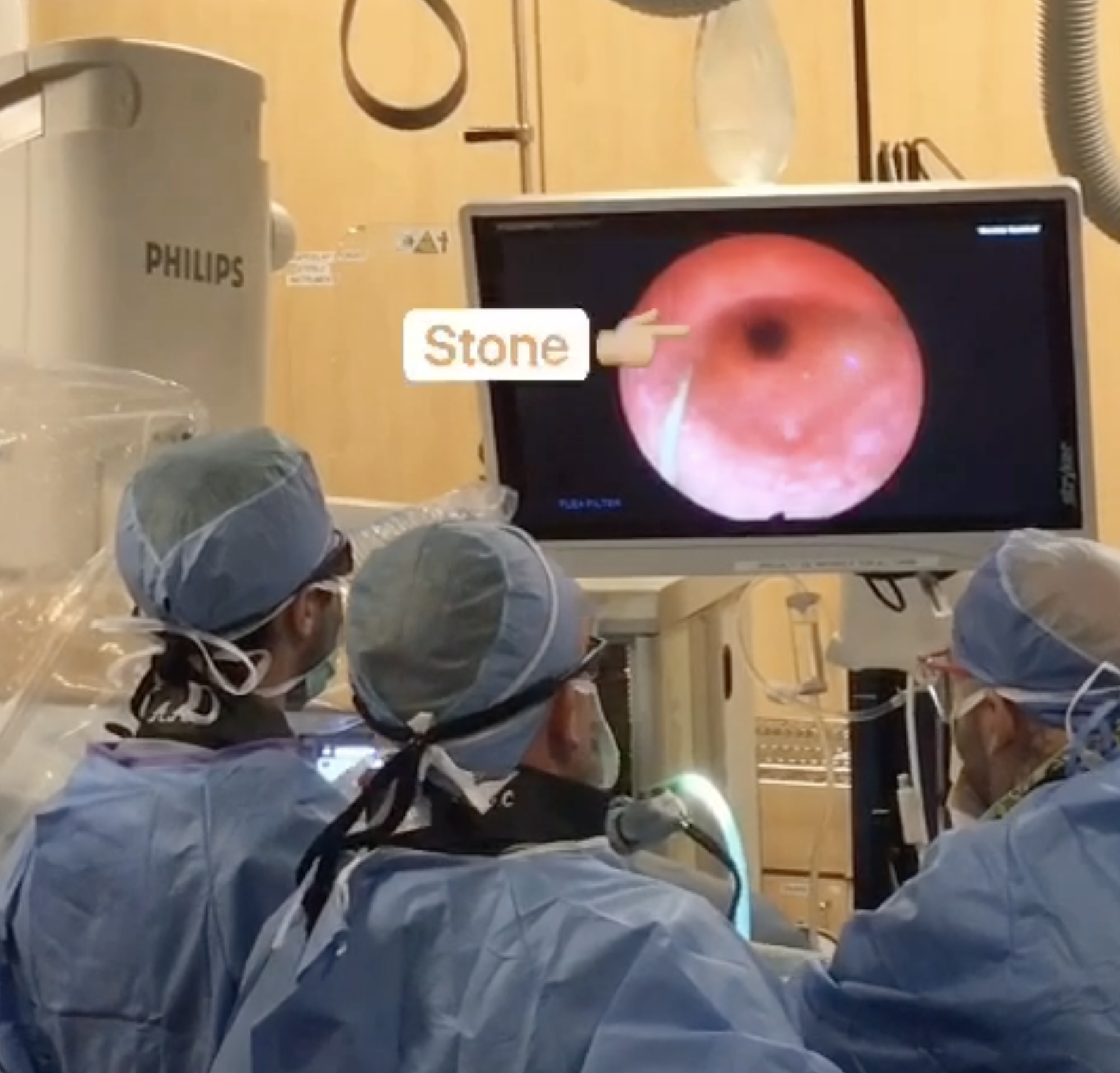 Non-Surgical Gallstone Removal - Cholangioscopy Technique